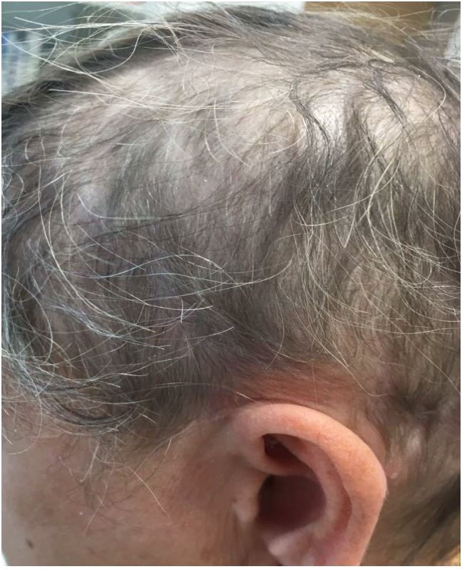 Alopecia Areata and Severe Psoriasis Successfully Treated with Apremilast - SciTeMed Publishing ...